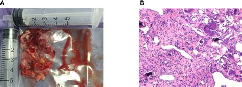 Frontiers Refractory And Progressively Worsening Nasal Obstruction