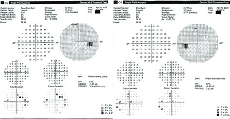 Visual Fields Od And Os At 5 Months Postoperatively Download Scientific Diagram
