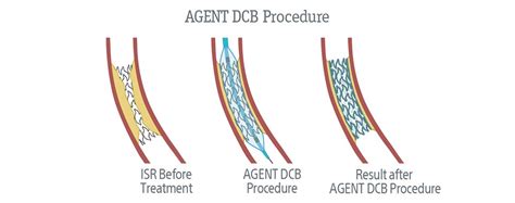 Understanding In Stent Restenosis ISR Boston Scientific