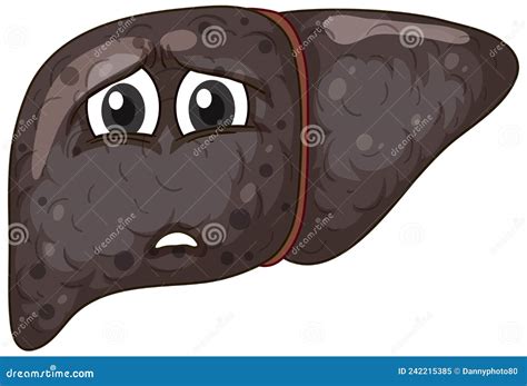 Cirrhosis Of The Liver Fibrosis Of The Liver Tissue Caused By Long