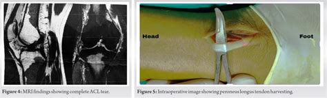 Acl Reconstruction In A Poliotic Limb With Peroneus Longus Graft Journal Of Orthopaedic Case
