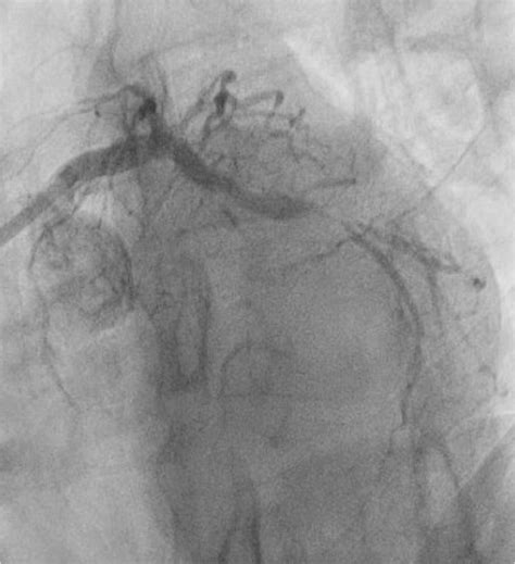 Feasibility Of Left Distal Transradial Access For Pci Case Discussion Isic The Indonesian