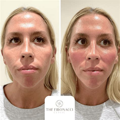 Cheek Fillers The Fibonacci Clinic