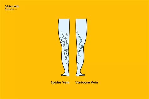 Discover The Latest Innovations In Varicose Vein And Spider Vein Treatment Metro Vein Centers