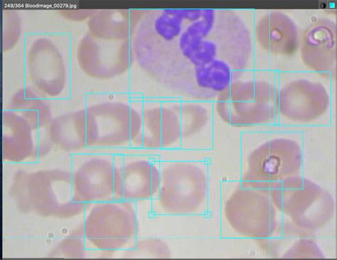 Releasing An Improved Blood Count And Cell Detection BCCD Dataset