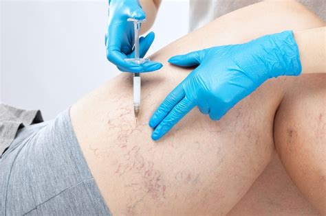 Viva Varicose Understanding The Highs And Lows Of Vein Health