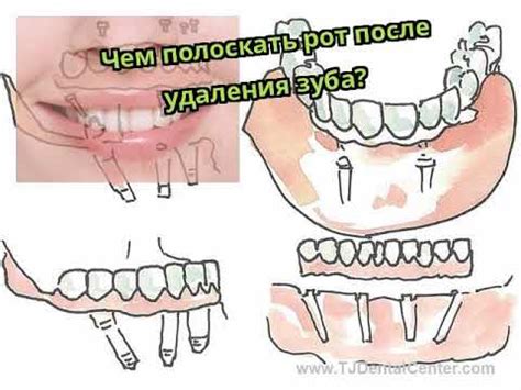 Чем полоскать рот после удаления зуба? - YouTube