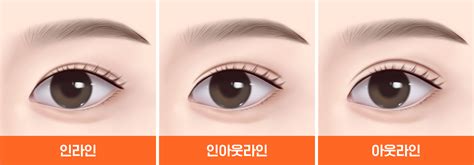 성형시술 잘 아는언니