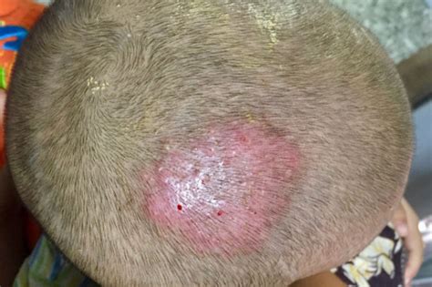 Кружен црв на скалпот габична инфекција на главата Panacea Mk