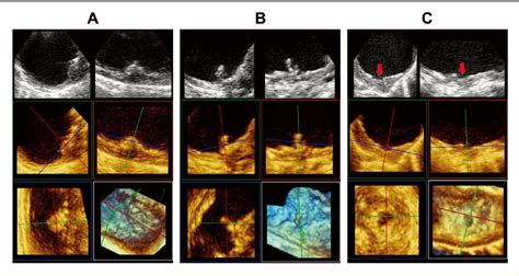 Figure 1 From Prevalence And Clinical Implication Of Complex