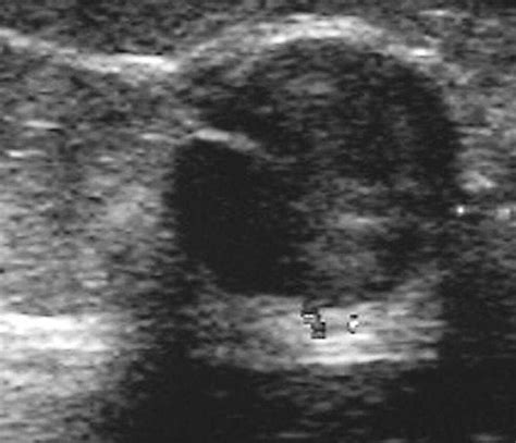 第2节 乳腺分叶状肿瘤 乳腺疾病影像