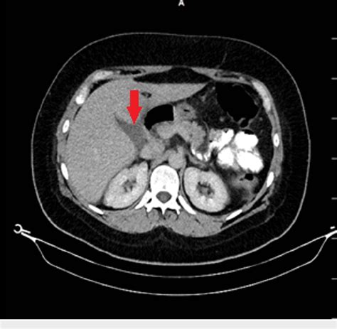 Figure 1 From Bile Leakage From The Luschka Duct After Laparoscopic