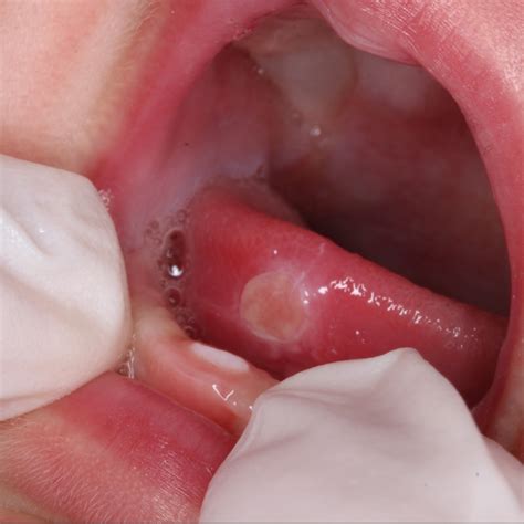 What Is The Riga Fede Ulcer Velez And Lozano