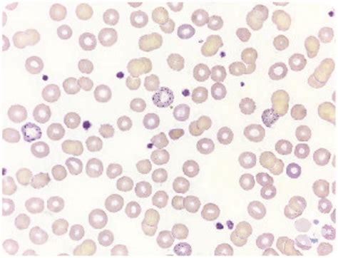 Basophilic Stippling
