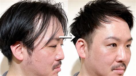 薄毛専門美容師が選ぶm字ハゲに似合う髪型 Relive 薄毛に悩む男性のための完全個室美容室
