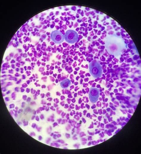 Acantholytic Cells