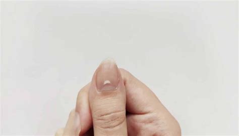 Nail Abnormalities Symptoms Causes And Prevention The Tiger News