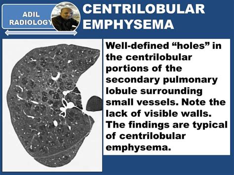 Centrilobular Emphysema Few Radiology Classroom Centrilobular Emphysema Few Radiology Classroom