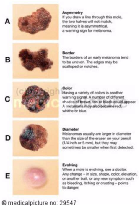 Abcde Melanoma Test Hand Out