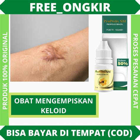 Obat Oles Keloid Kempis Dengan Alami Keloid Menonjol Keloid Di