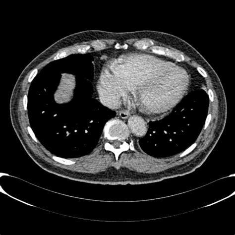 Cholangiocarcinoma Radiopaedia 49009 54379 A Nc Commons