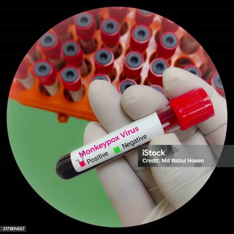 Blood Sample For Monkey Pox Virus Is A Disease Caused By Infection With