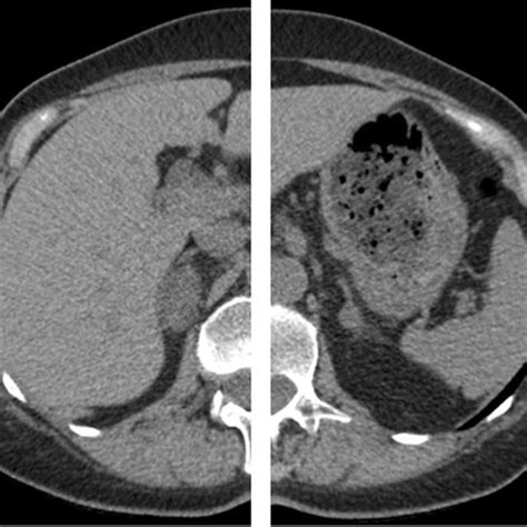 Patient With Mild Autonomous Cortisol Secretion Macs And Bilateral