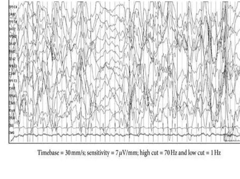 Abnormal Eeg Patterns Pptx
