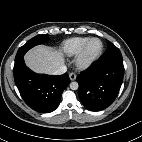 Patent Urachus Radiology Case Interventional