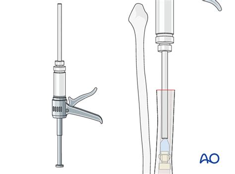 Proximal Tibia Replacement For Fracture Around A Loose Tibial Component