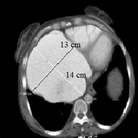 Postoperative Ct Figure 2 Preoperative Ct Download Scientific Diagram