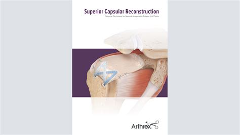 Arthrex Arthroflex® Decellularized Dermal Allograft