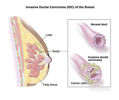 Definition Of Infiltrating Ductal Carcinoma NCI Dictionary Of Cancer Terms NCI
