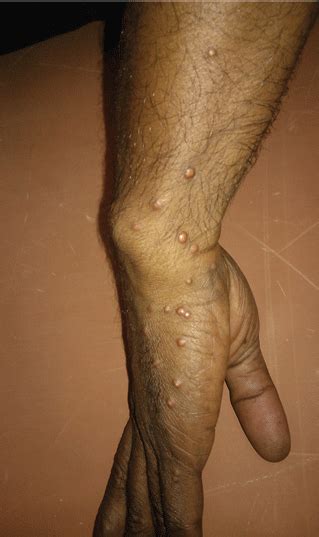 Eruptive Xanthoma Warning Sign Of Systemic Disease Cleveland Clinic