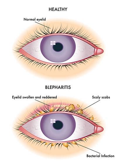 Blepharitis Itchy Dry Eyelids Treatment · Top Eye Doctors · Midtown Nyc