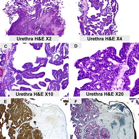 Opened Radical Circumcision Specimen Showing Tumour On Inner Mucosal Download Scientific