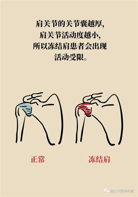 肩膀疼的原因很多抻一抻爬爬墙 会缓解 医学界 助力医生临床决策和职业成长