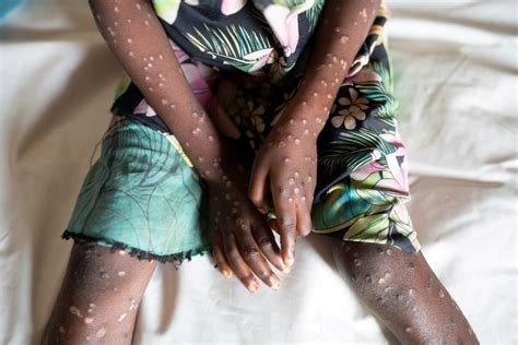La Oms Cambia El Nombre De La Viruela Del Mono A Mpox Con Acento