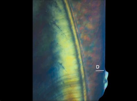 Cpp Acp And Fluoride A Synergism To Combat Caries Abstract Europe Pmc