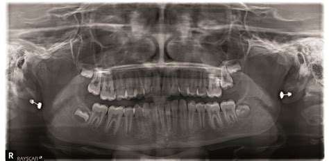 Brava A Novel Orthodontic System Resolves A Functional Shift