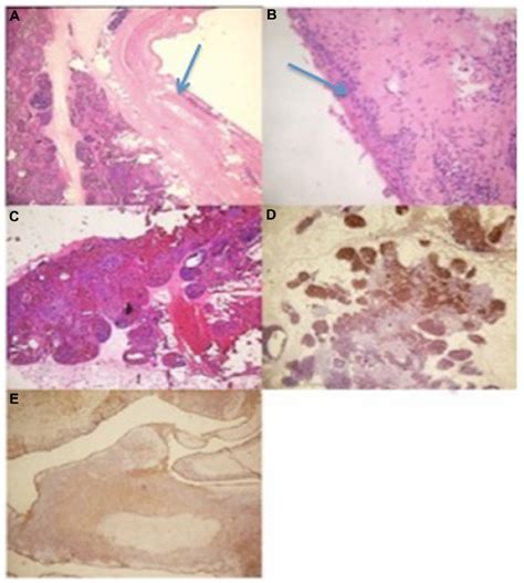 A Unilocular Thymic Cyst Associated With True Thymic Hyperplasia A Ch