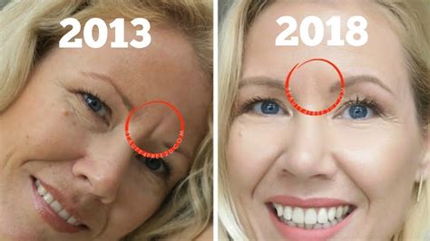 How To Get Rid Of Furrow Lines Between Eyebrows