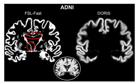 figure red circles show wm csf partial volume incorrectly classified as