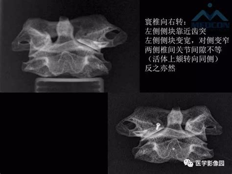 寰枢关节脱位的影像学诊断，看完我就收藏了！ 好医术文章 好医术 赋能医生守护生命