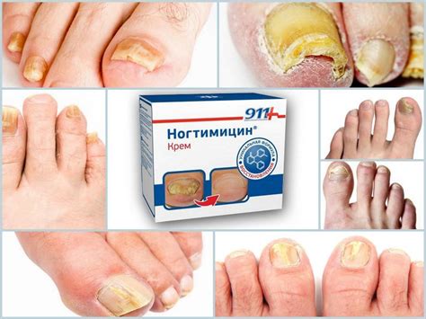 Грибок ступней: как выглядит (фото) и чем лечить микоз стоп