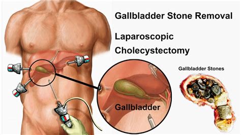 Understanding Gallstones And Gallbladder Surgery A Simplified Guide