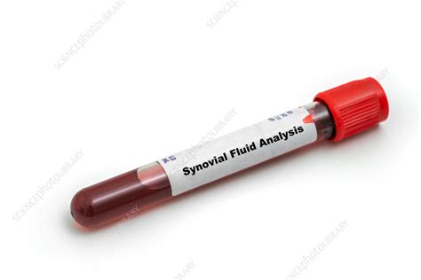 Synovial Fluid Analysis Conceptual Image Stock Image F037 0536