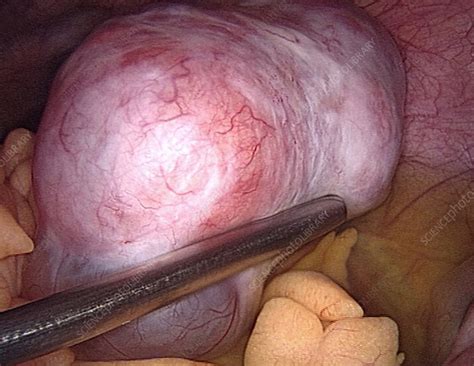 Ovarian Cyst Laparoscopy Stock Image C0292416 Science Photo Library