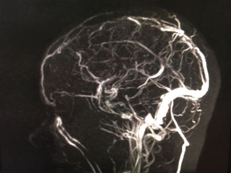 Superior Saggital Sinus Thrombosis Sinusitis Thrombosis Radiology