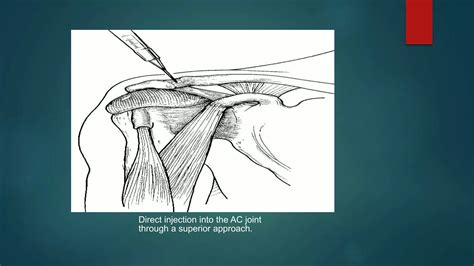 Acromioclavicular Joint Arthritis Ppt